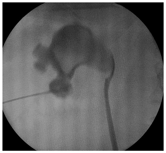 Mini-Perc for Renal Stones—A Single Center Experience and Literature Review