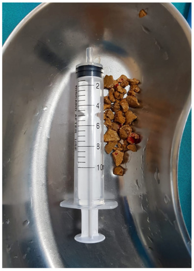 Mini-Perc for Renal Stones—A Single Center Experience and Literature Review