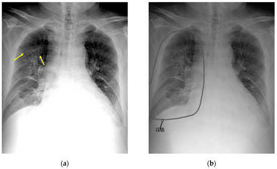 Methods of Visualizing the Results of an Artificial-Intelligence-Based ...