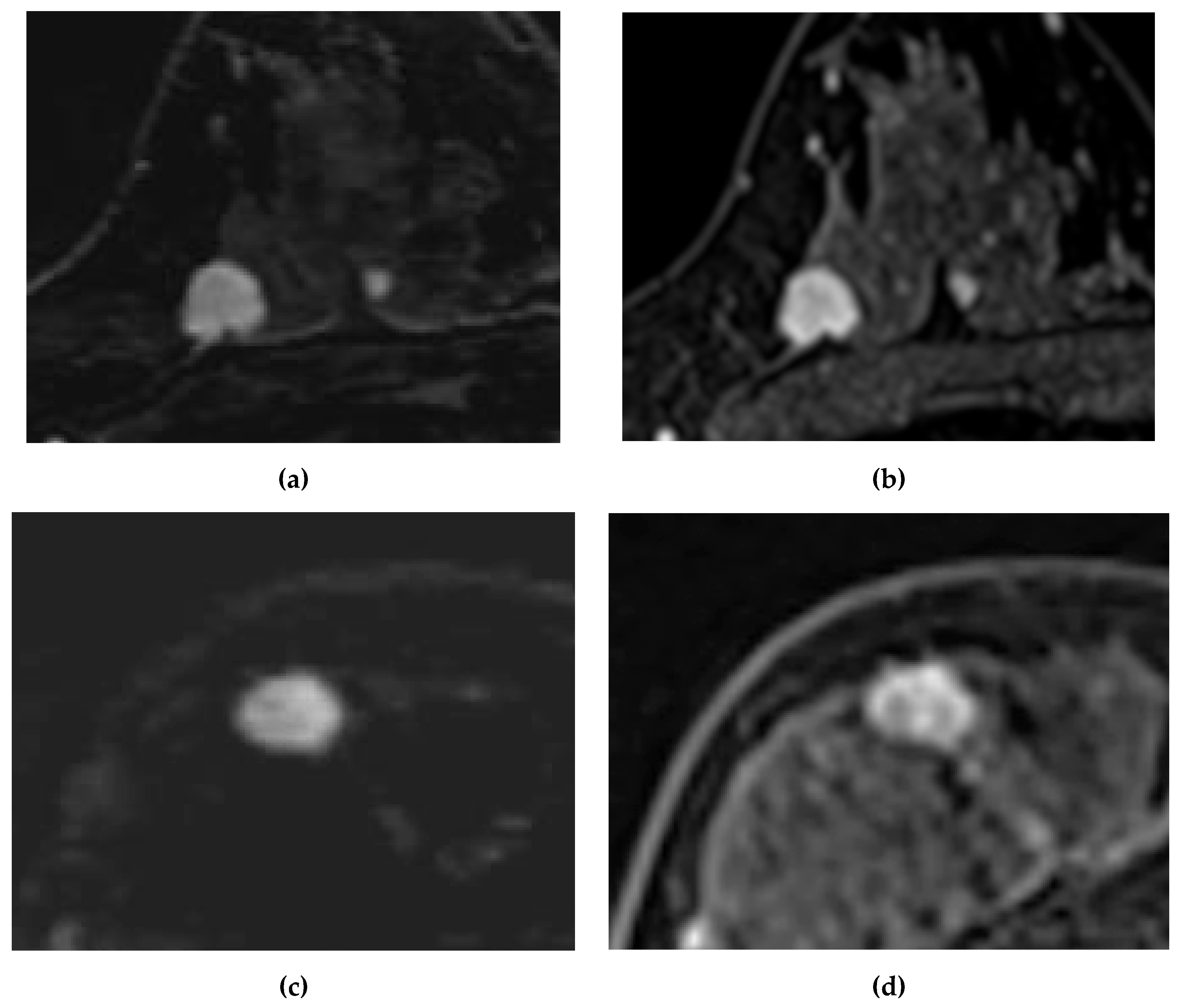 Diagnostics Free Full Text Comparison Of Ultrafast Dynamic Contrast