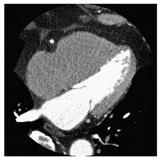 Noise Reduction Using Singular Value Decomposition with Jensen–Shannon ...