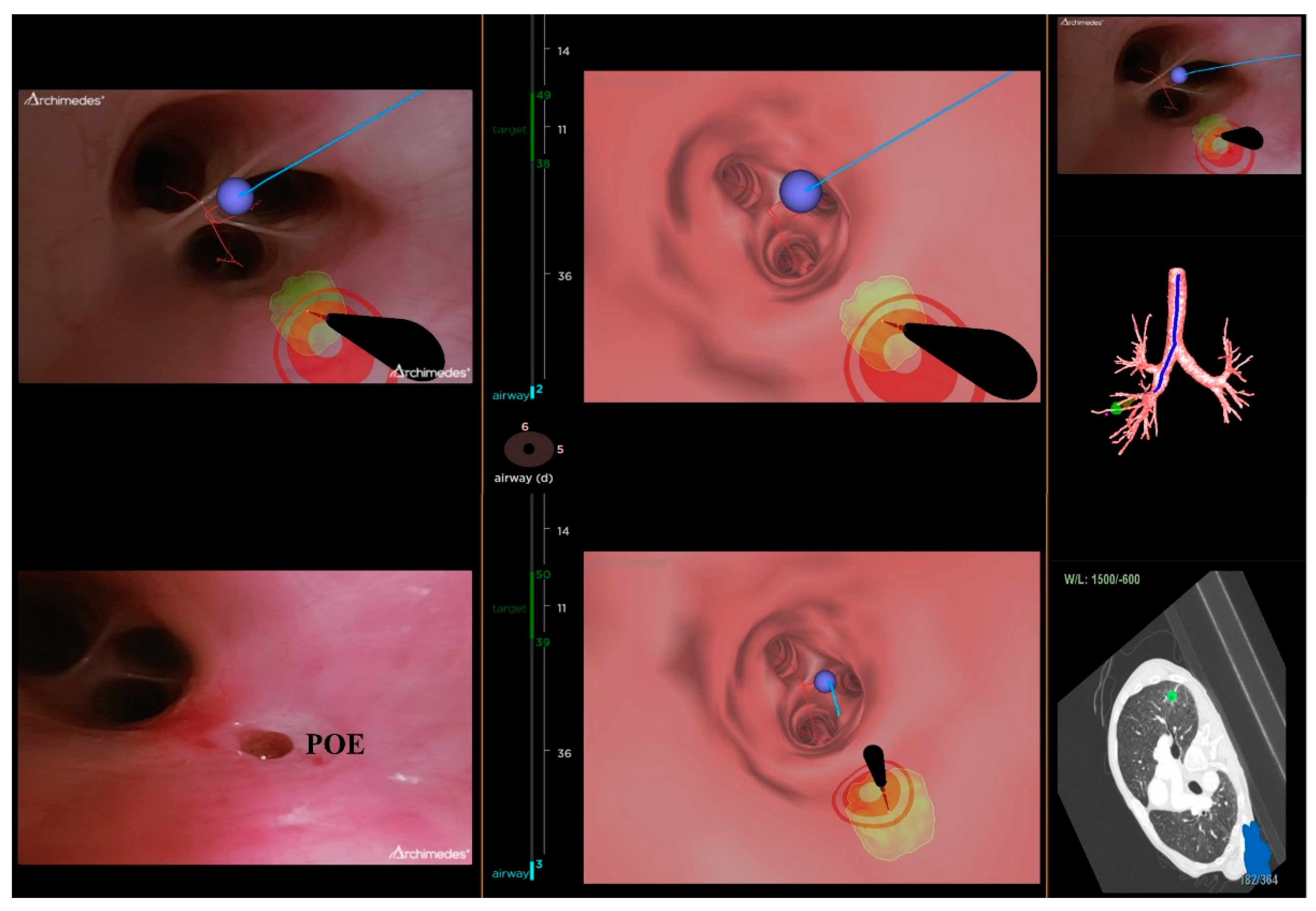 Diagnostic Performance of Electromagnetic Navigation versus Virtual Navigation Bronchoscopy ...