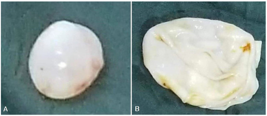 Hydatid Disease: A Radiological Pictorial Review of a Great Neoplasms ...
