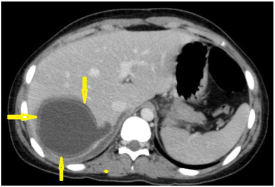 Hydatid Disease: A Radiological Pictorial Review of a Great Neoplasms ...