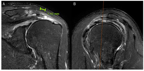 Diagnostics | Free Full-Text | Delaminated Tears of the Rotator Cuff ...