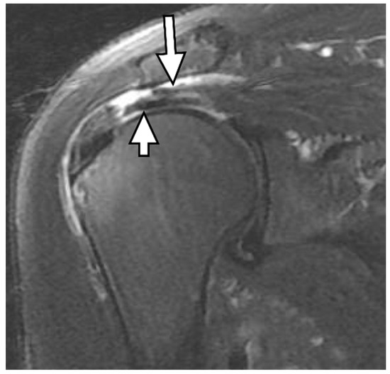 Delaminated Tears of the Rotator Cuff MRI Interpretation with Clinical Correlation