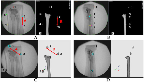 Comparison of 3D Bone Position Estimation Using QR Code and Metal Bead ...