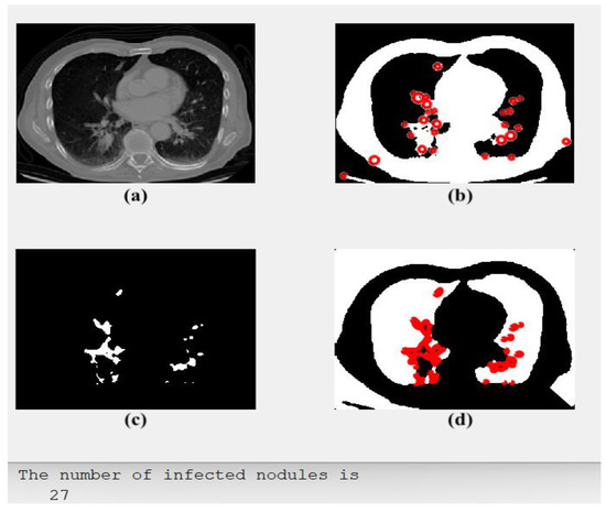 A CAD System for Lung Cancer Detection Using Hybrid Deep Learning ...