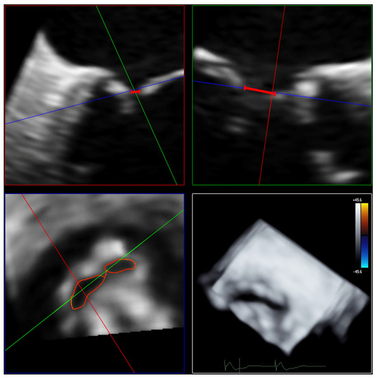 Benefit of 3D Vena Contracta Area over 2D-Based Echocardiographic ...