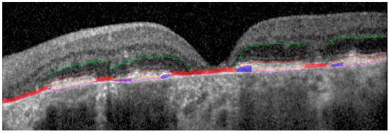 Automated Identification and Segmentation of Ellipsoid Zone At-Risk ...