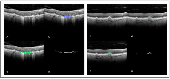 Automated Identification and Segmentation of Ellipsoid Zone At-Risk Using Deep Learning on SD ...