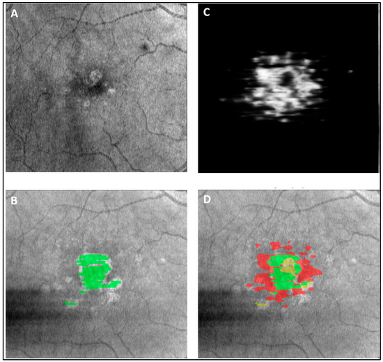 Automated Identification and Segmentation of Ellipsoid Zone At-Risk Using Deep Learning on SD ...
