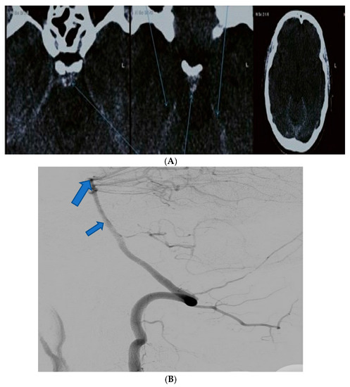Non-Aneurysmal Perimesencephalic Subarachnoid Hemorrhage: A Literature ...