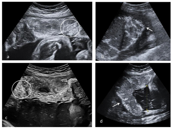Ultrasound Placental Remodeling Patterns and Pathology Characteristics ...
