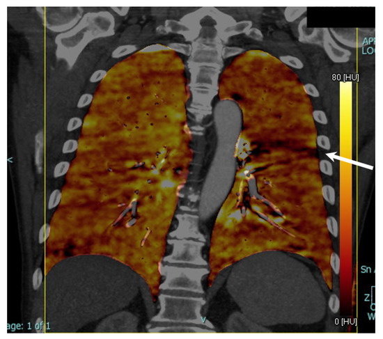 Quantitative Assessment of Lung Volumes and Enhancement in Patients ...