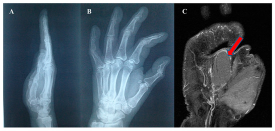 Rare Benign Tumors and Tumor-like Lesions of the Hand without Skin ...