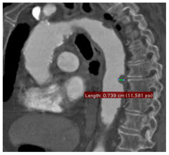 Single-Center Experience with Simultaneous Mural Aortic Thrombosis and ...