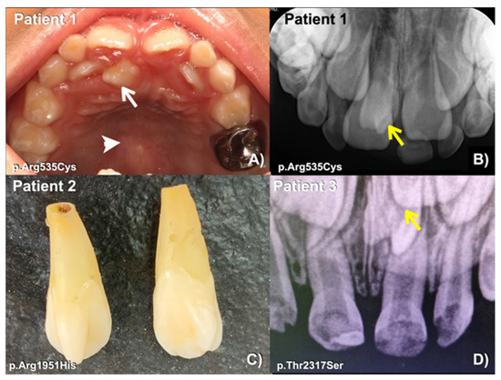 Heterozygous Variants in FREM2 Are Associated with Mesiodens ...