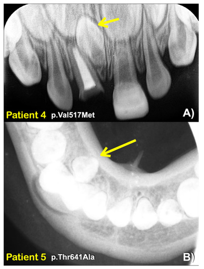 Heterozygous Variants in FREM2 Are Associated with Mesiodens, Supernumerary Teeth, Oral ...