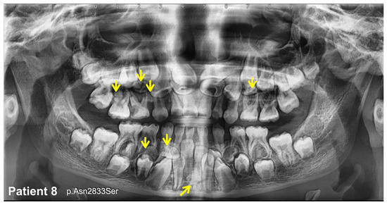 Heterozygous Variants in FREM2 Are Associated with Mesiodens ...