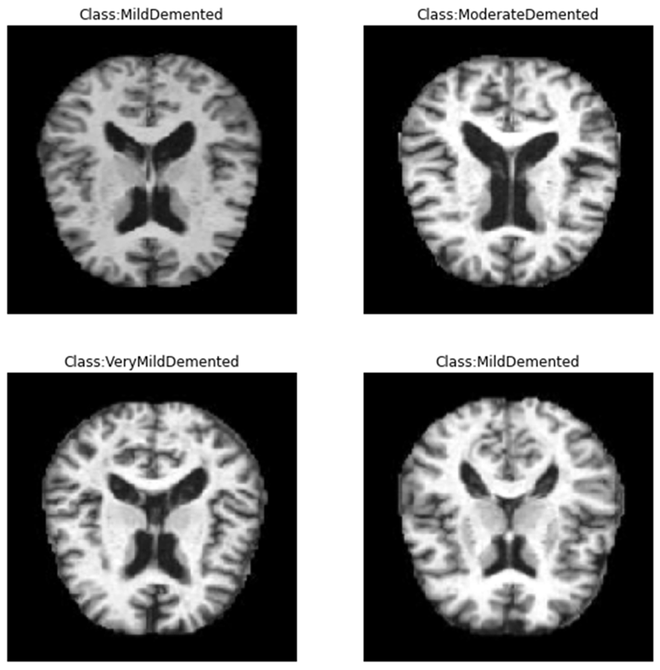 Accurate Detection of Alzheimer’s Disease Using Lightweight Deep ... Accurate Detection of Alzheimer’s Disease Using Lightweight Deep ...