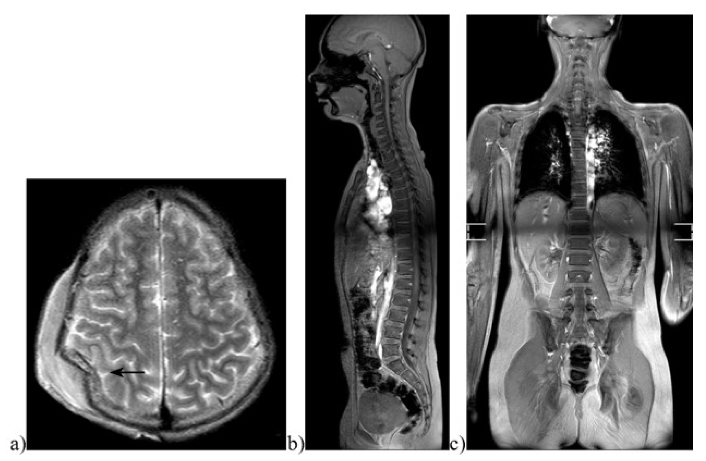 Whole-Body Magnetic Resonance Tomography and Whole-Body Computed Tomography in Pediatric ...