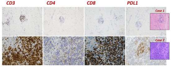 What Can Trigger Spontaneous Regression of Breast Cancer?