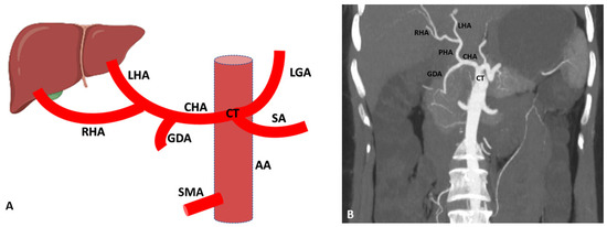 Importance of Anatomical Variation of the Hepatic Artery for ...