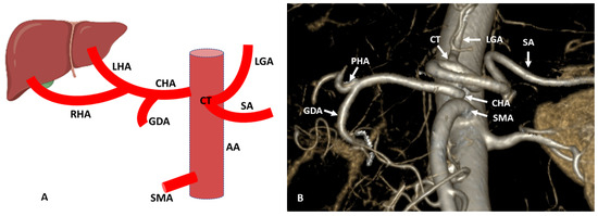 Importance of Anatomical Variation of the Hepatic Artery for ...