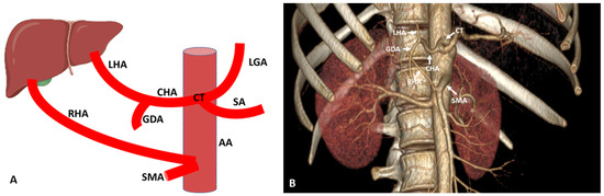 Importance of Anatomical Variation of the Hepatic Artery for ...