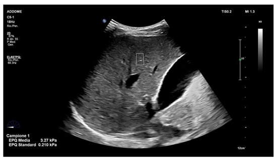 Liver Ultrasound Cirrhosis