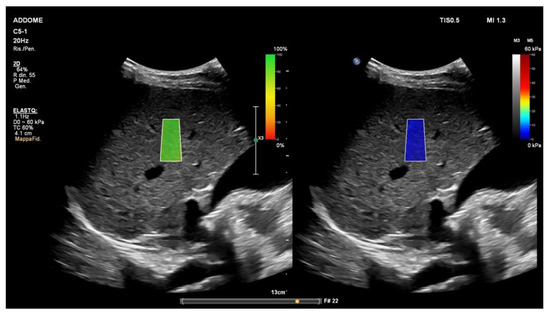 Liver Ultrasound Elastography in Non-Alcoholic Fatty Liver Disease: A ...