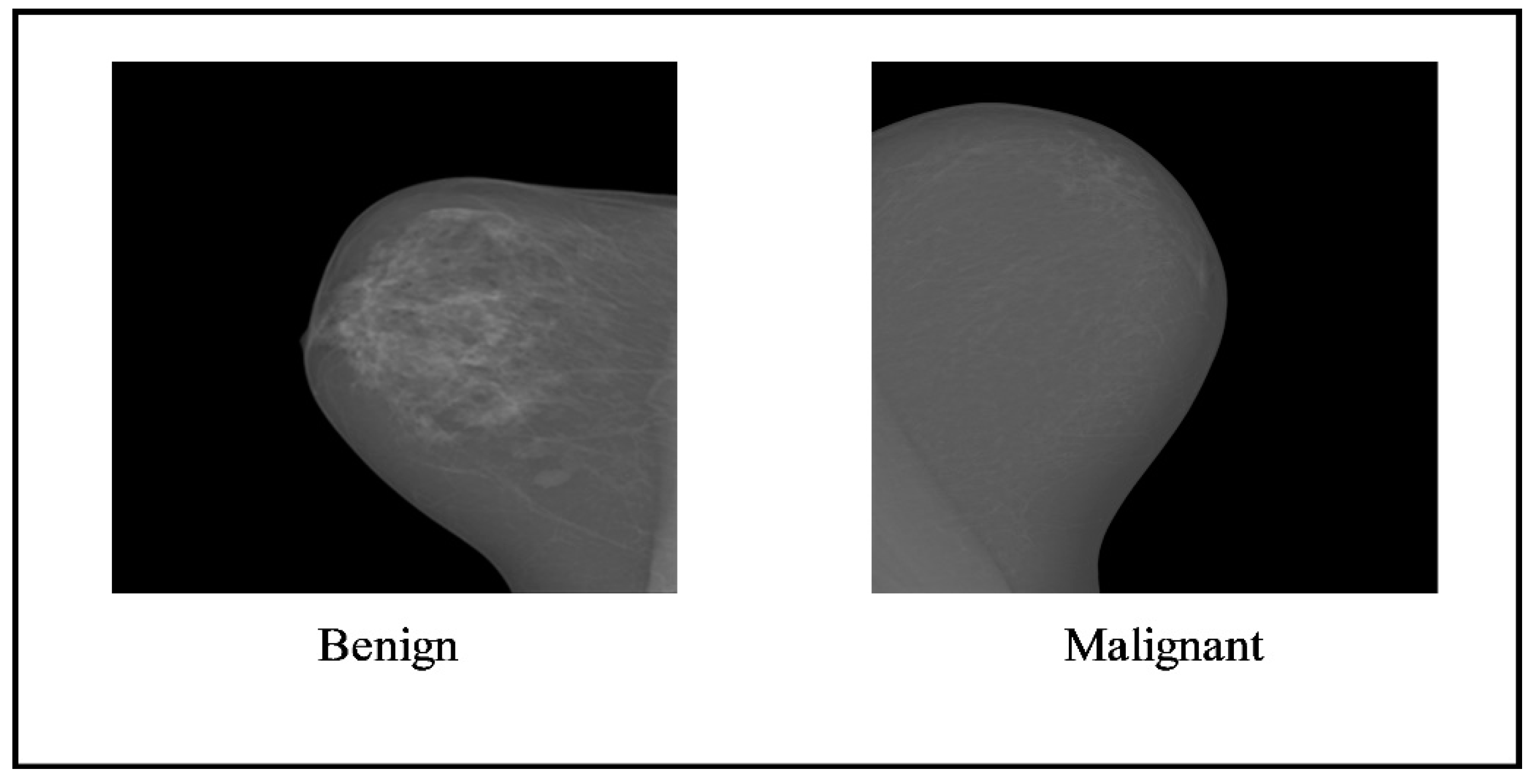 BC2NetRF: Breast Cancer Classification from Mammogram Images Using ...