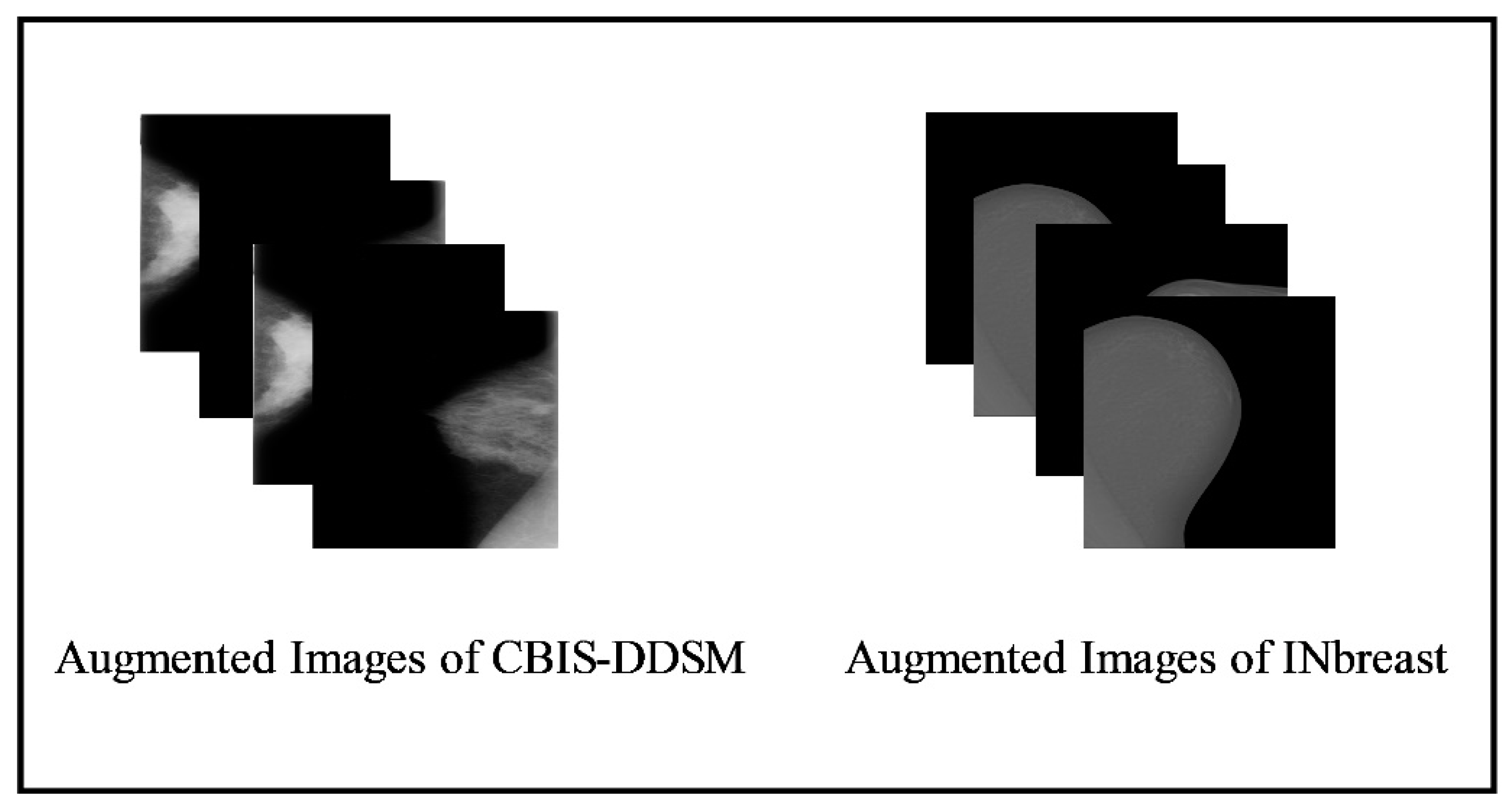 BC2NetRF: Breast Cancer Classification from Mammogram Images Using ...