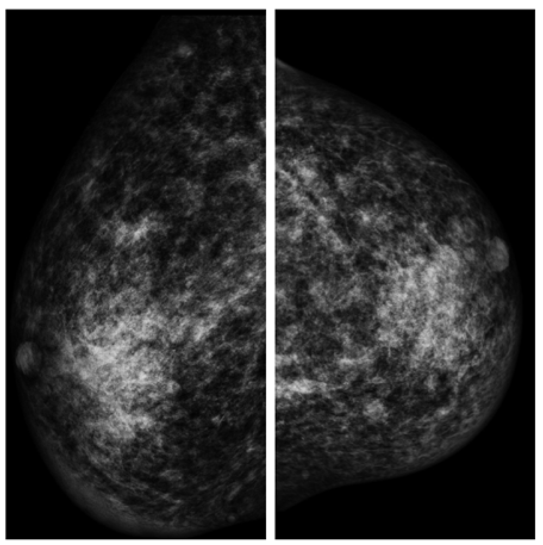Erdheim–Chester Disease of the Breast: First Review and First Case of ...