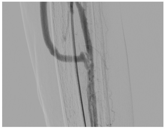 Long-Term Results of Below-The-Knee Bypass Using a Prosthetic Graft ...