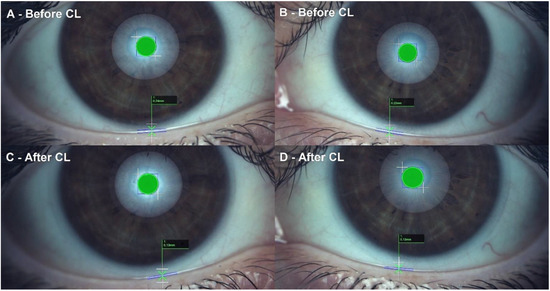 Evaluation of Celligent® Biomimetic Water Gradient Contact Lens Effects ...
