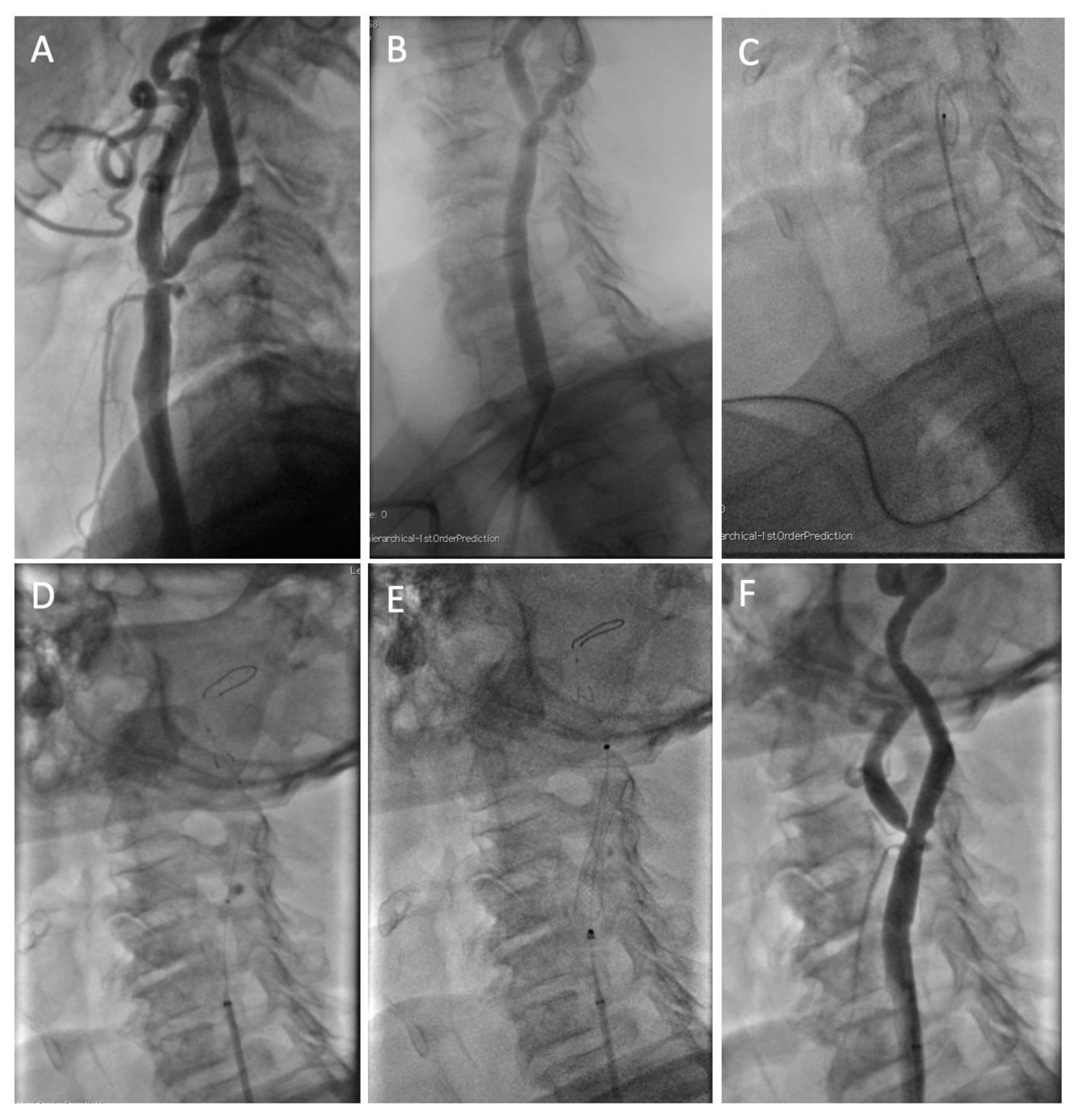 Carotid Artery Stenting Using Five-French Distal Radial Vascular Access