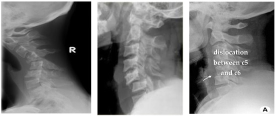 Classification of Cervical Spine Fracture and Dislocation Using Refined Pre-Trained Deep Model ...