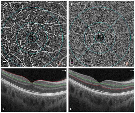 Analysis of Optical Coherence Tomography (OCT) and Optical Coherence ...