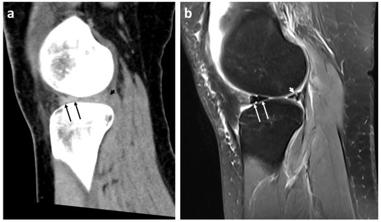 Diagnostic Accuracy of 128-Slice Single-Source CT for the Detection of ...
