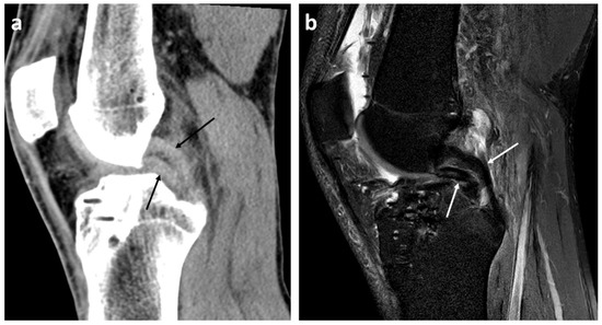 Diagnostic Accuracy of 128-Slice Single-Source CT for the Detection of ...
