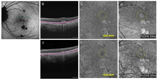 Diagnostics | Free Full-Text | OCT Angiography in Noninfectious Uveitis ...