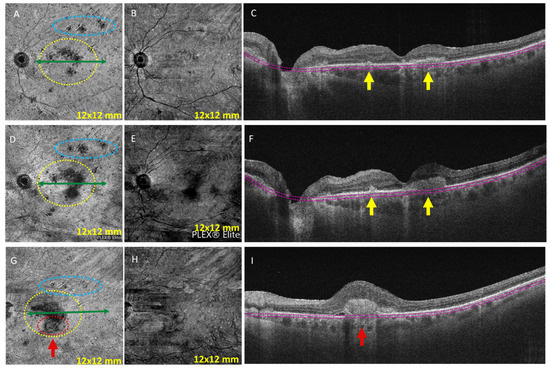 Diagnostics | Free Full-Text | OCT Angiography in Noninfectious Uveitis ...