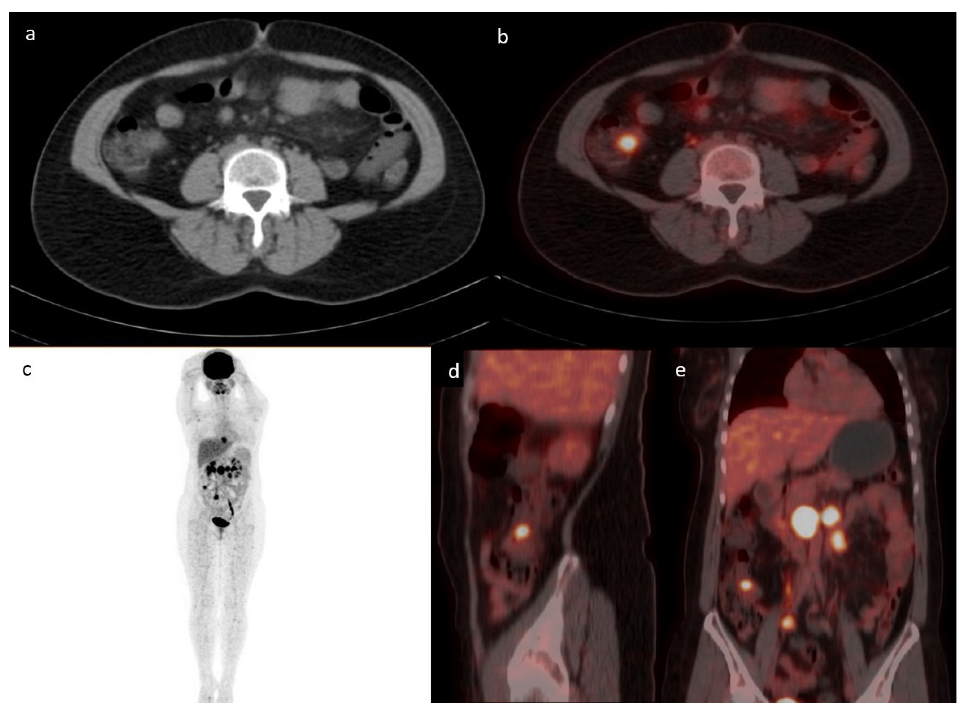 The Clinical Significance of Incidental GIT Uptake on PET/CT ...