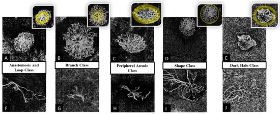 CNV-Net: Segmentation, Classification and Activity Score Measurement of ...