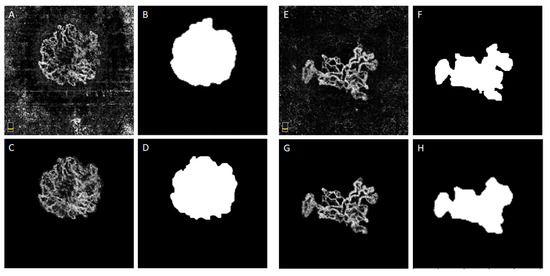 CNV-Net: Segmentation, Classification and Activity Score Measurement of ...