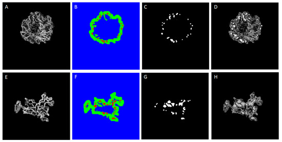 CNV-Net: Segmentation, Classification and Activity Score Measurement of ...