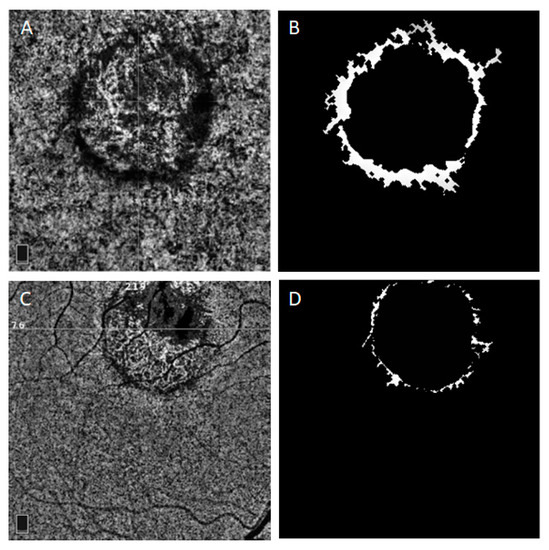 CNV-Net: Segmentation, Classification and Activity Score Measurement of ...