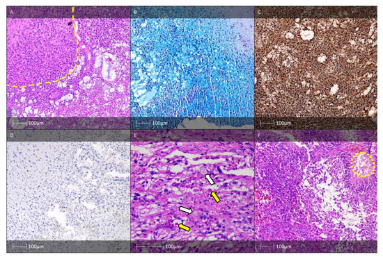 Pathomorphological Diagnostic Criteria for Focal Cortical Dysplasias ...